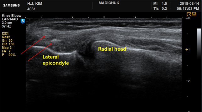 [NO.8] Tennis elbow:Calcific tendinitis,acute inflammation