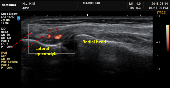 [NO.8] Tennis elbow:Calcific tendinitis,acute inflammation