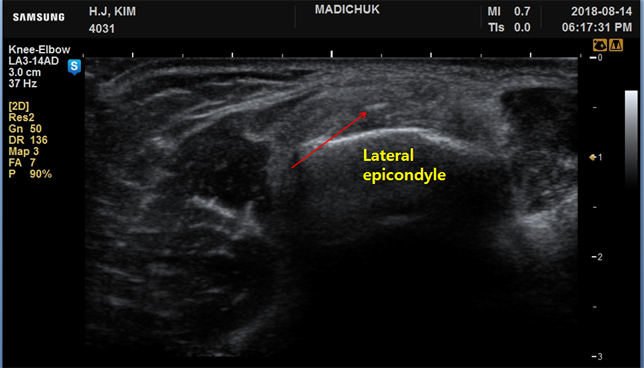 [NO.8] Tennis elbow:Calcific tendinitis,acute inflammation