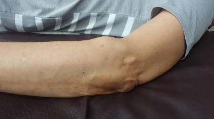 [NO.9] Ganglion cyst in brachiradialis m. at elbow