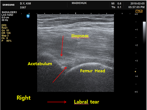 [NO.17] Femoroacetabular Impingement (FAI) and acetabular labral tear
