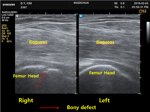 [NO.17] Femoroacetabular Impingement (FAI) and acetabular labral tear